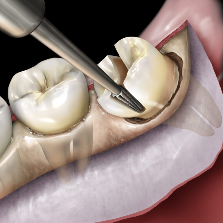 FRESA CARBIDE CIRUGIA,FG,#701-012,TRONCOCONICA,SSWHITE - Devale Dental ...